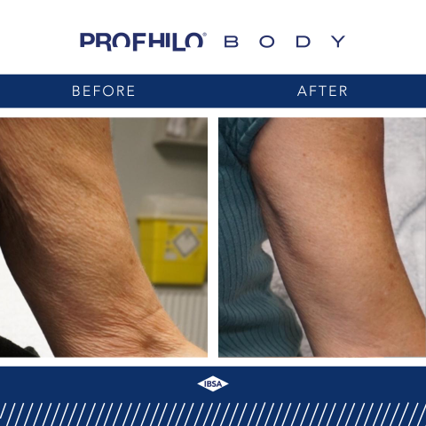 Profhilo Body - Moerman Clinic Groningen